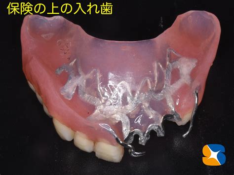 511 入れ歯の値段は全国同じなのにこれだけ違う使用感 ブルーラジカル歯周病治療 大阪 奈良 Newスタイル鈴木歯科