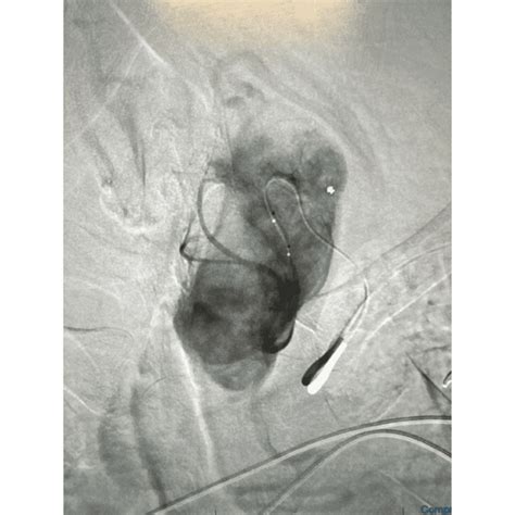 Thyroid Artery Embolization Florida Interventional Specialists