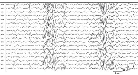 Example Of Interictal Epileptiform Discharges Ieds During Sleep A