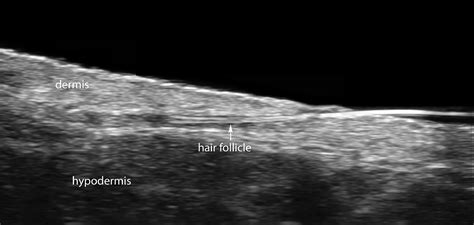 Practical Applications Of Ultrasound In Dermatology Clinics In Dermatology