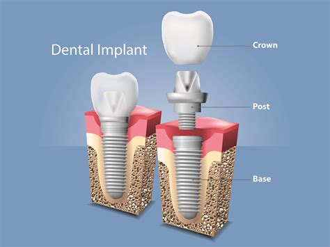 Dental Implants Procedures Richard A Urbanek Jr Dds Ms Pa