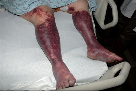 Non Blanching Rashes Module Dont Forget The Bubbles