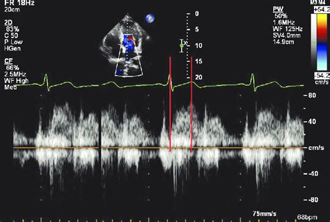 Pulmonary Pulse Transit Time Is Defined As The Time Interval Between