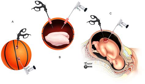 Illustration Showing The 2 Portals Model A Shows A Superior View Of Download Scientific