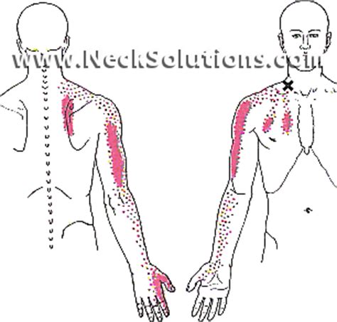 Scalene Muscles Trigger Points