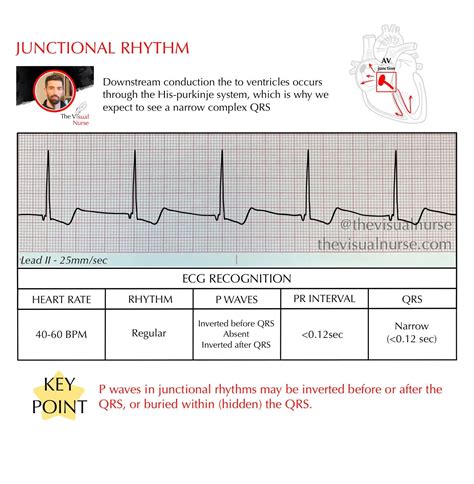 Av Nodal Junctional Rhythm