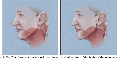 Platysma