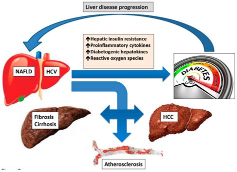 Hepatitis C Liver Disease