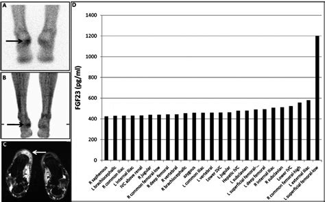 Example Of A Positive Result On Selective Venous Sampling A Suspicious