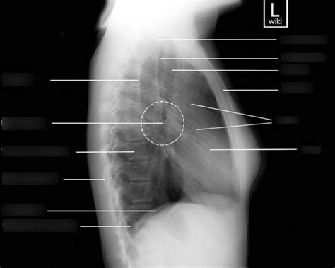 Left Lateral Chest Diagram Quizlet