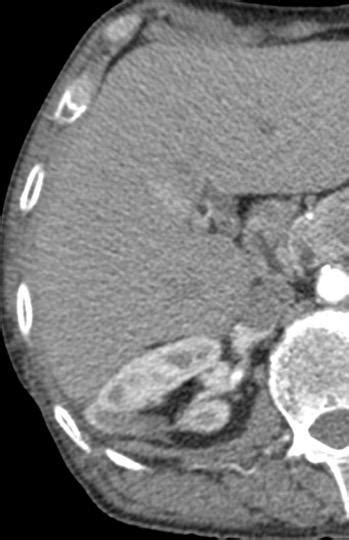 A Rare Complication After Partial Nephrectomy Eurorad