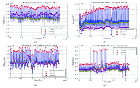 results of the suggested optimum iir filter technique for qrs peak
