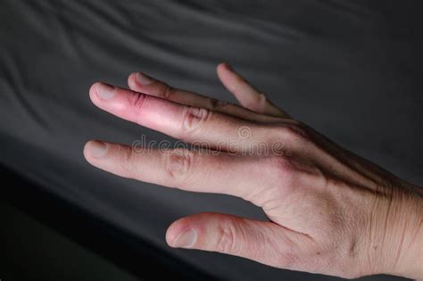 Mallet Finger Healing After Splint Removal From Middle Finger Following