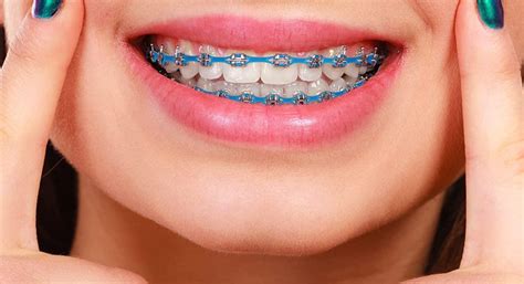 Orthodontic Emergency Braces Diamond Braces