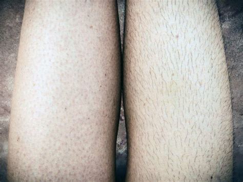 Bumpy Legs Causes Of Red Bumps And Spots On Legs