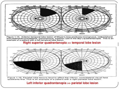 Quadrantanopia Eye Unilateral Optic Nerve Hypoplasia In A Patient Desiring
