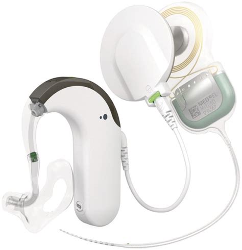 Radiation Induced Sensorineural Hearing Loss And Potential Management