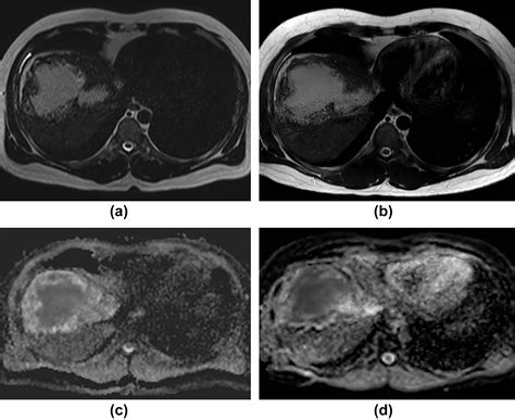 Hepatic Alveolar Hydatid Disease Echinococcus Multilocularis A Mimic