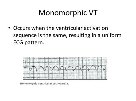 Ppt Ventricular Tachycardia Powerpoint Presentation Free Download