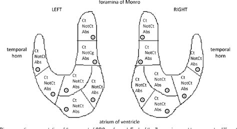 Figure 1 From Endoscopic Third Ventriculostomy And Choroid Plexus Cauterization In Infant