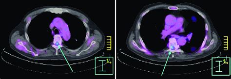 Multiple Focal Hypermetabolic Nodules Are Observed In The Spinal Space Download Scientific