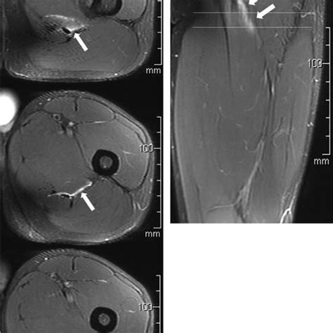 Grade 2 Hamstring Muscle Strain Involving The Right Biceps Femoris Download Scientific Diagram