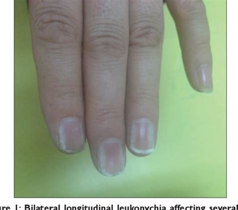 Leukonychia Partialis