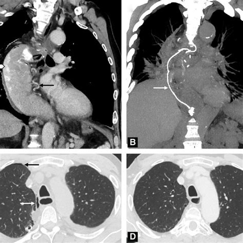 X Ray Demonstrating Retrocardiac Lucency Arrow From A Type Iii Download Scientific Diagram