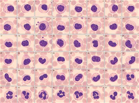 Jle Annales De Biologie Clinique Acquired Pelger Huët Anomalyabnormal Chromatin Clumping Of