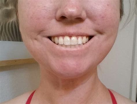 Scleroderma Lips Photos