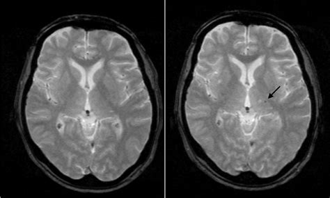 Example Of Progression Of Brain Microbleed On Axial T2 Weighted Download Scientific Diagram