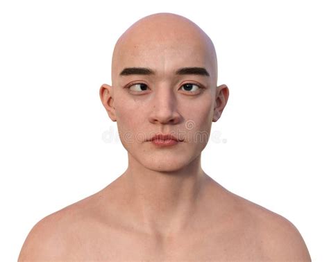 A Man With Esotropia 3d Illustration Stock Illustration Illustration Of Optometry Medicine