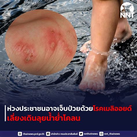 Nbt Connext ห่วงประชาชนอาจเจ็บป่วยด้วยโรค “เมลิออยด์”