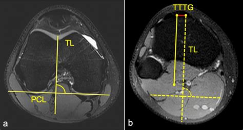Determination Of The Tttg Distance Using Fat Suppressed Pd Weighted