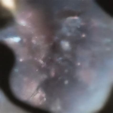 Understanding Lymphangitis Comprehensive Overview