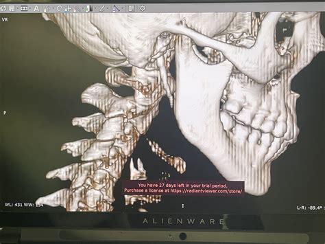 Angle Of Styloid Processes General Living With Eagle