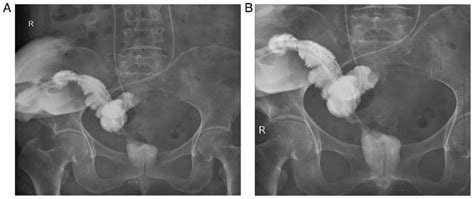 A Contrast Agent Was Injected From The Ileostomy Drainage Tube For An Download Scientific
