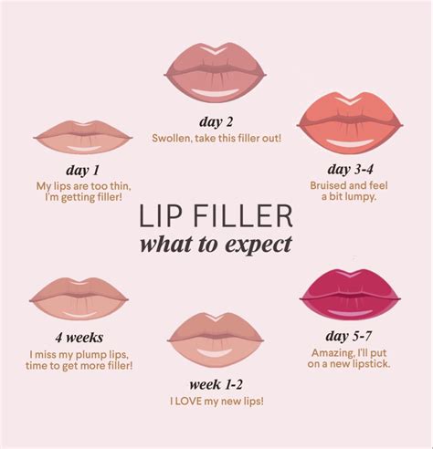 Lip Filler Graphic Lip Fillers Facial Aesthetics Facial Fillers