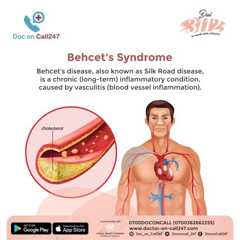 Behcets Syndrome