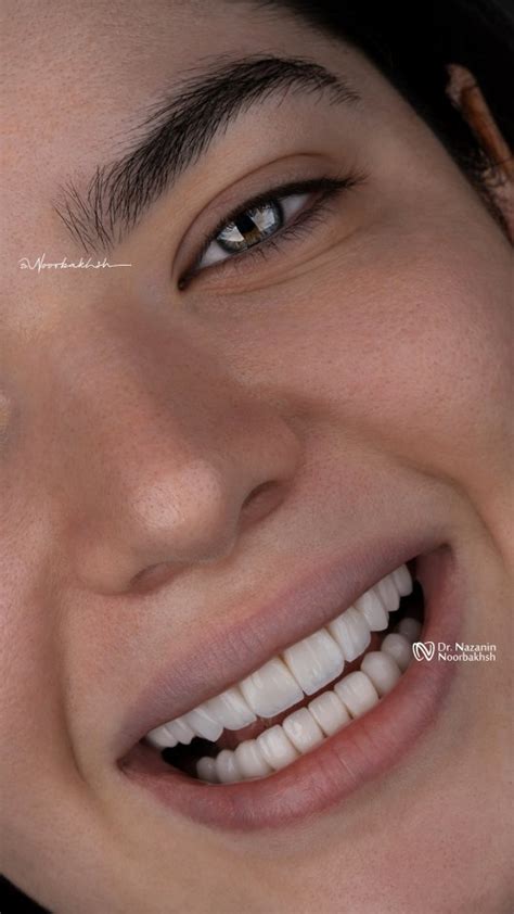 ‎dr Nazanin Noorbakhsh دکتر نازنین نوربخش‎ ‎🤩design Your Dream Smile