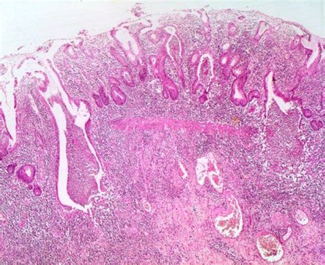 Ibd Flashcards Quizlet