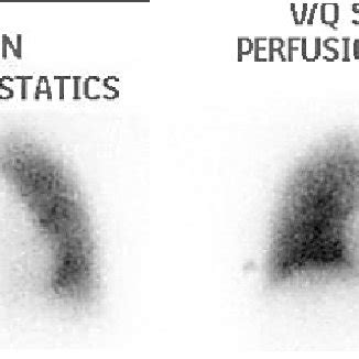 Ventilation Perfusion Lung Scan Showing Ventilation And Perfusion Download Scientific Diagram