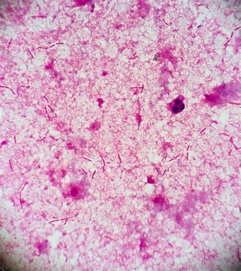 Fusobacterium Necrophorum〔壊死桿菌〕 グラム染色 Gram Stain