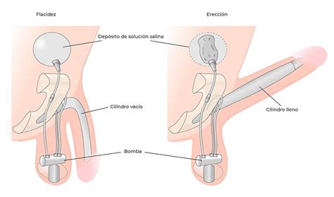 Prótesis De Pene Para La Disfunción Eréctil Una Guía Completa