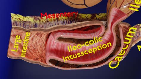 Intussusception Intestine Ileocolic Obstruction 3d Turbosquid 2414944