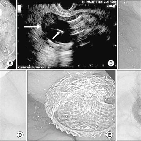 A 66 Year Old Female With Metastatic Cholangiocarcinoma And Gastric
