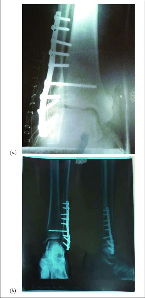 Implanted Ankle Joint A Treated Joint At The First Surgery B Download Scientific Diagram