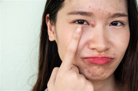 Acne Grading Scale Knowing Your Acne Type