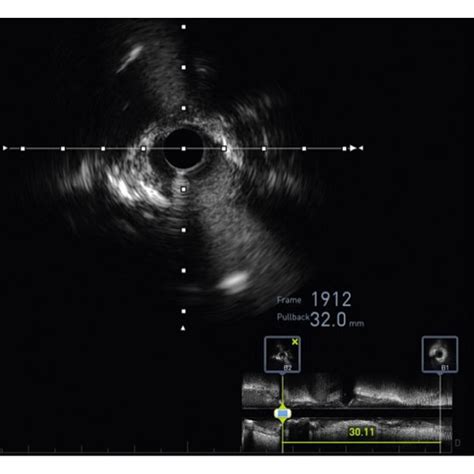 Ivus Catheter Is In True Lumen Surrounded By 3 Layers Intima Media And