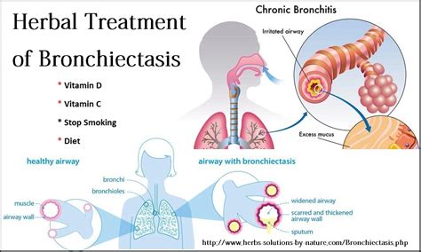 People Who Suffering From Bronchiectasis Herbal Treatment Herbs Solutions By Nature Blog